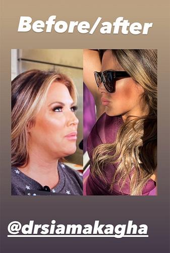 When Did 'RHOC' Star Emily Simpson Get a Facelift?