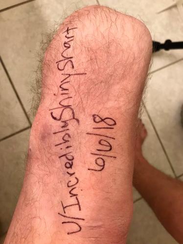 Man Has Leg Amputated And Invites Friends To Eat Tacos Made Of His Feet