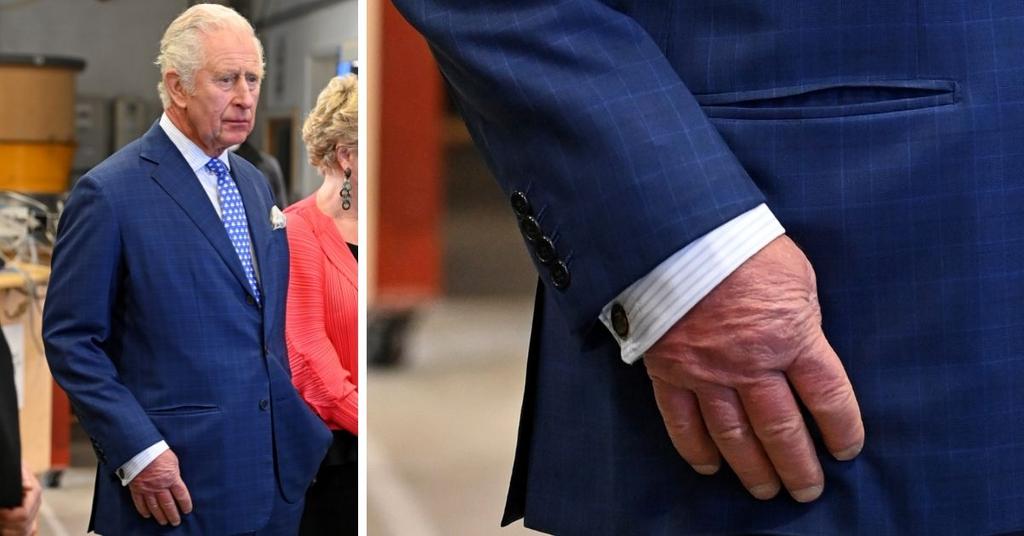 Prince Charles' Swollen Fingers Have Gone Viral! Details