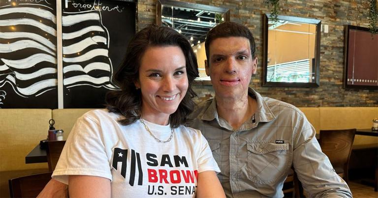 What Happened to Sam Brown's Face?