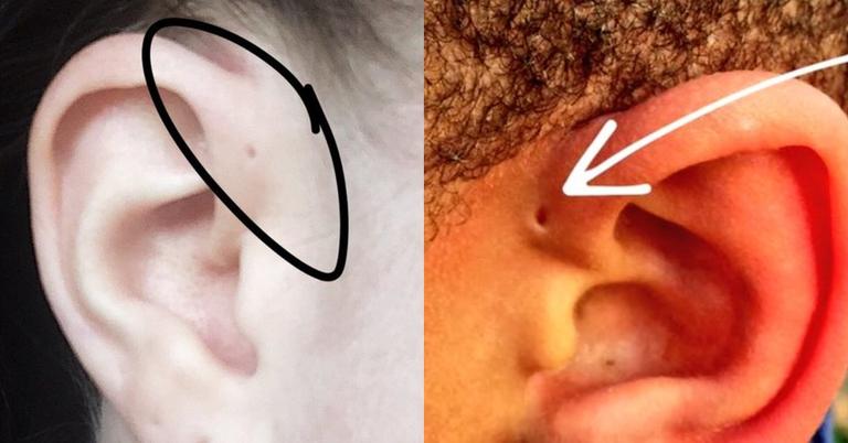 People Are Learning the Tiny Holes Above Their Ears Can Be Explained by ...