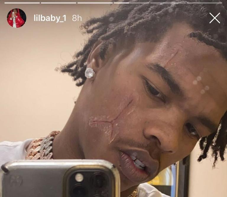 What Happened to Lil Baby's Face? Don't Worry, the Scars Aren't Real