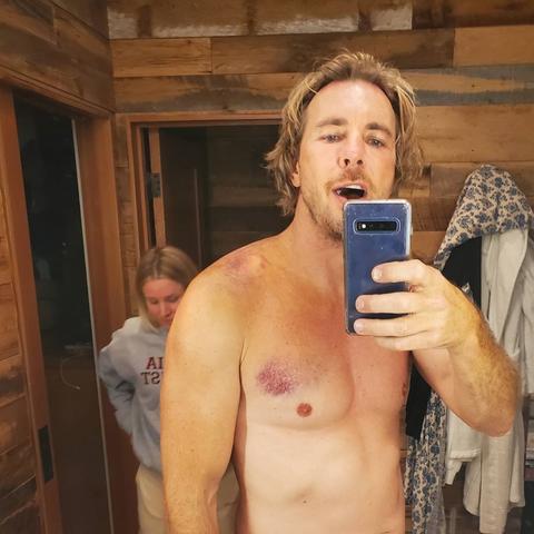 What Happened to Dax Shepard? Actor Has 4 Broken Ribs, Needs Surgery