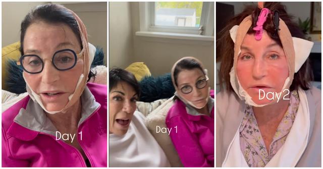 Kathy From The Golden Bachelor Undergoes Major Face Lift