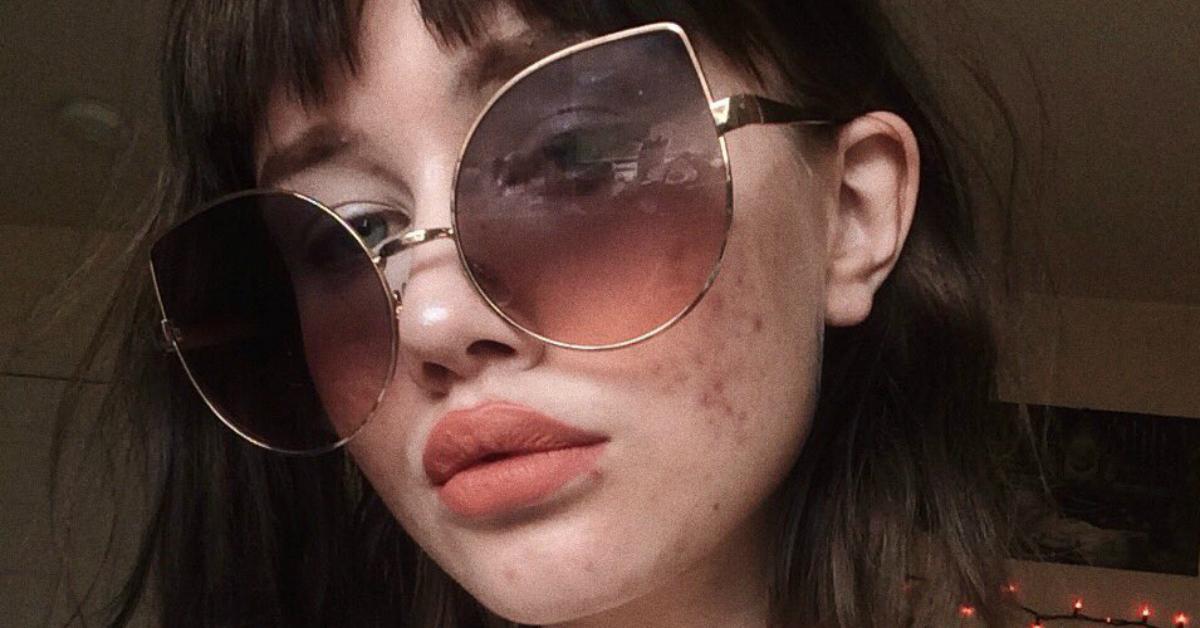 Girl With Cystic Acne Is Getting Rid of 'Pimple Stigma' By Going Makeup ...