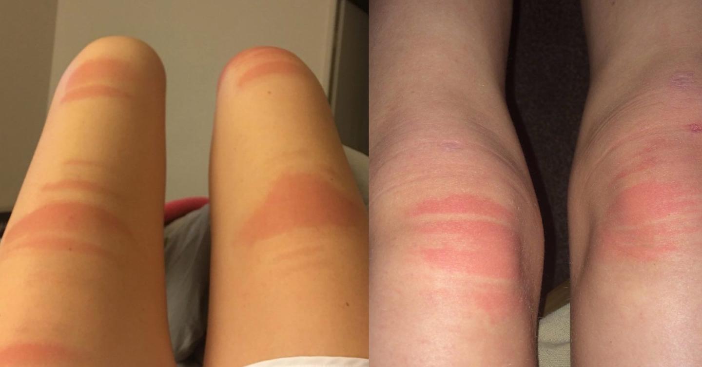 Ripped Jeans Leave the Worst Sunburns Ever