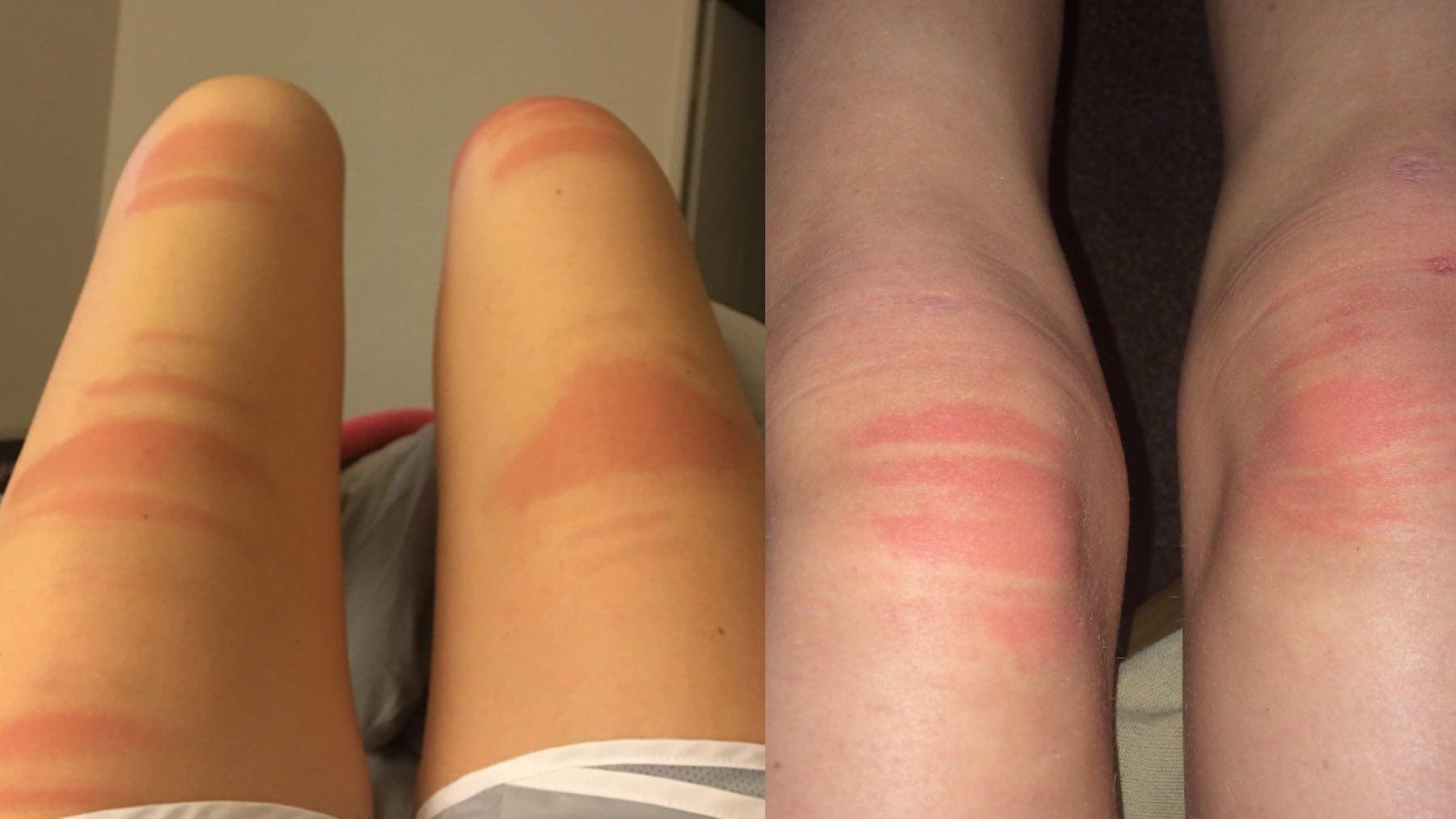 Ripped Jeans Leave the Worst Sunburns Ever