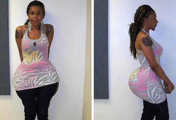 Botched Plastic Surgery – People Who Shouldn't Have Skimped on Getting ...