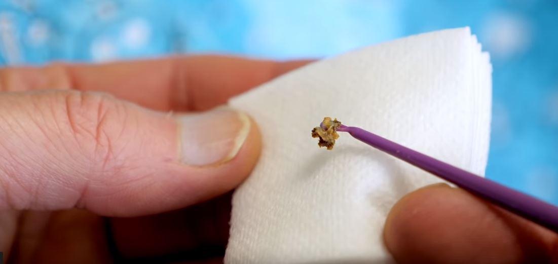 This Guy Developed a Skull Infection From Using Cotton Swab