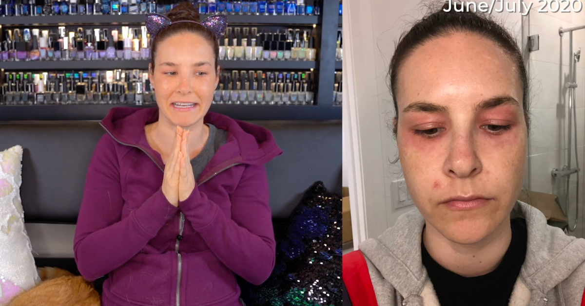 What Happened to Simply Nailogical's Face? She Explained What Happened